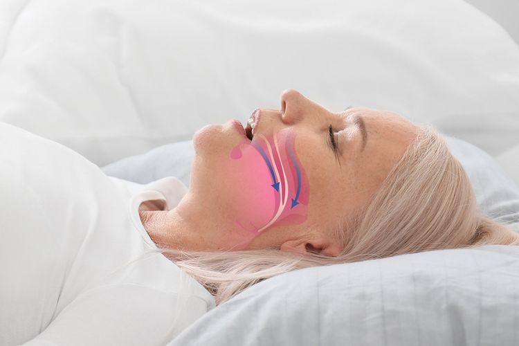 Apa Itu SLeep Apnea Jateng Live